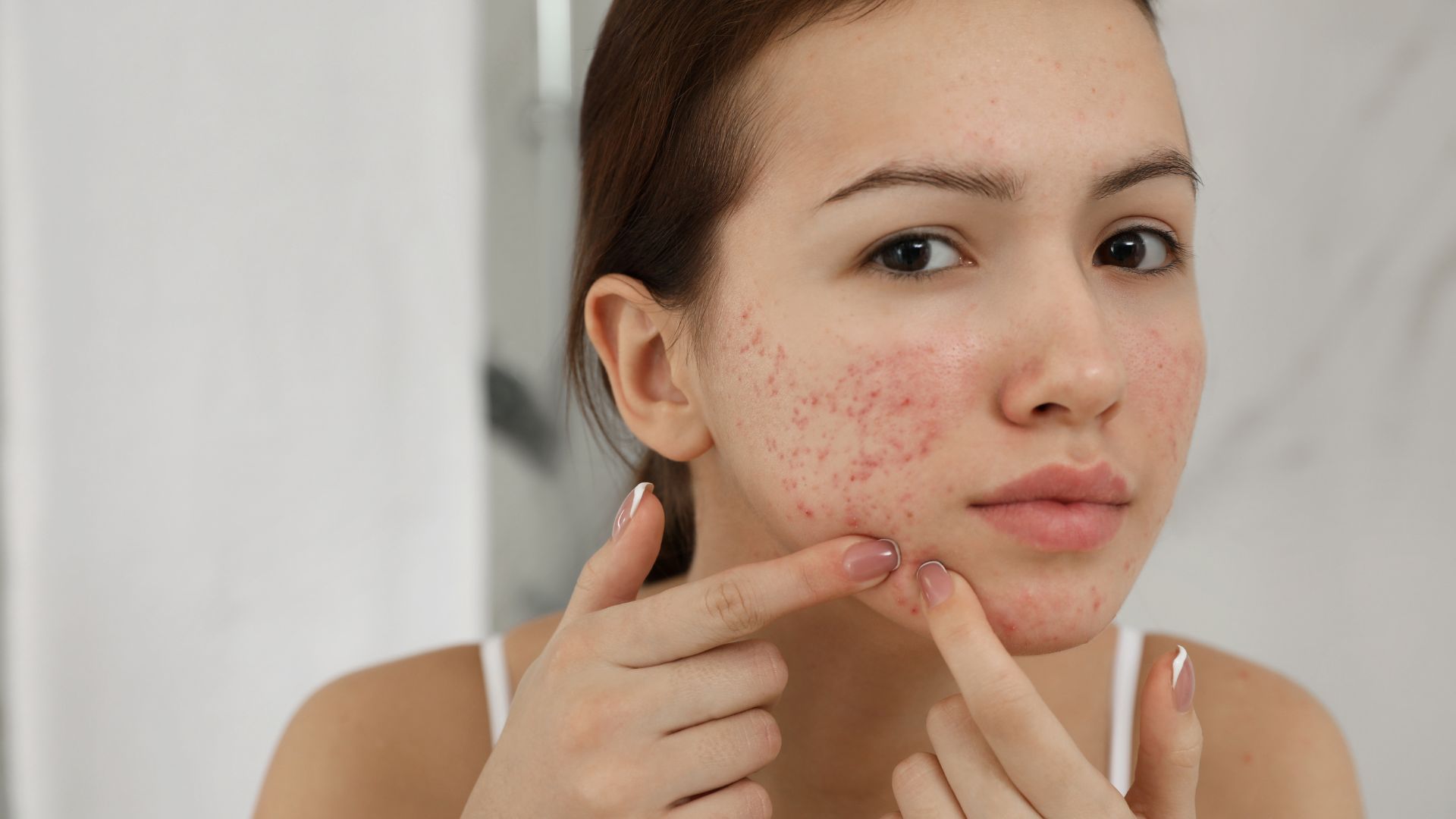 11 Homemade Face Masks For Acne Scars: What They Don't Tell You ...